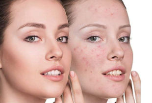 Mycose cutanée - Candida ou dermatophytes - L'Aromathérapie